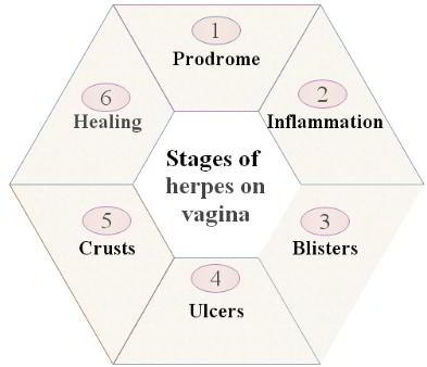 Herpes on vagina and herpes on vulva: How to eliminate them? ⚕